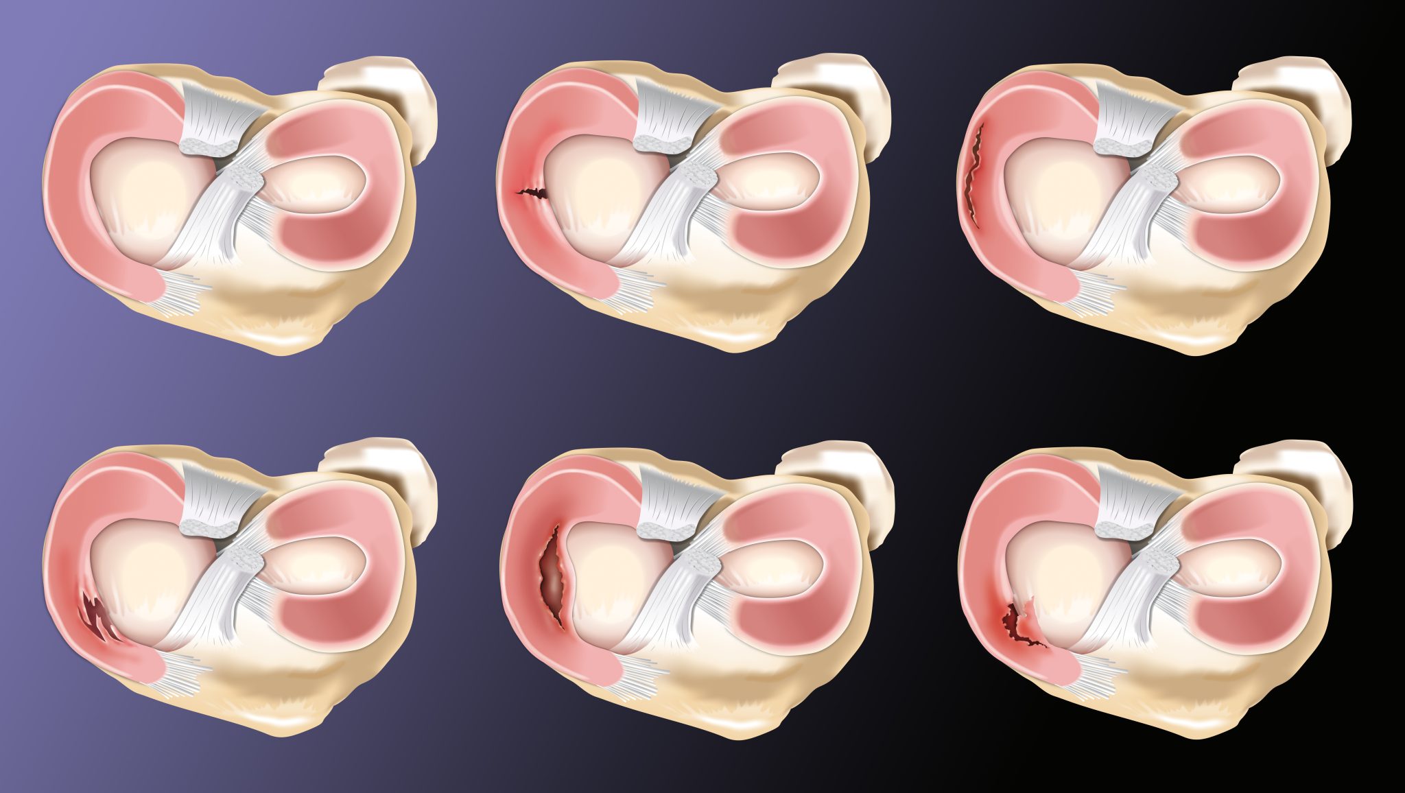 Meniskusoperation | Meniskus OP in Wien | Orthopäde Dr. Gruber