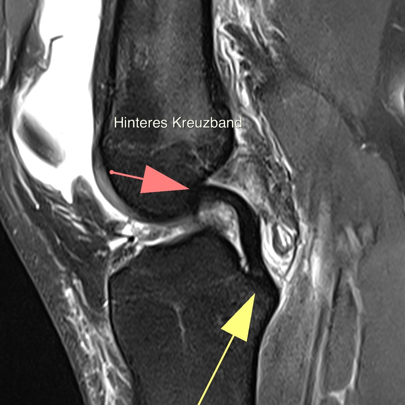 Verletzung des vordere Kreuzbandes & Wurzelläsion | Orthopäde Wien - Dr ...