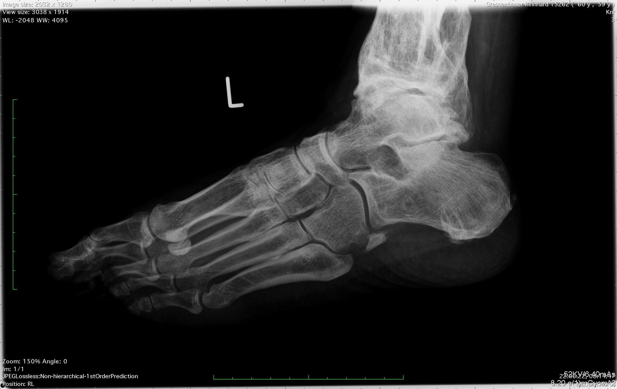Ankle joint endoprosthesis | Orthopedist Vienna