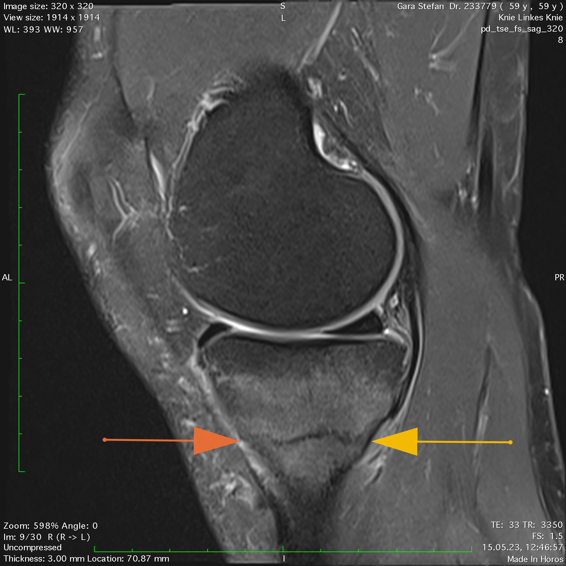 Stress fracture | Orthopedist Vienna