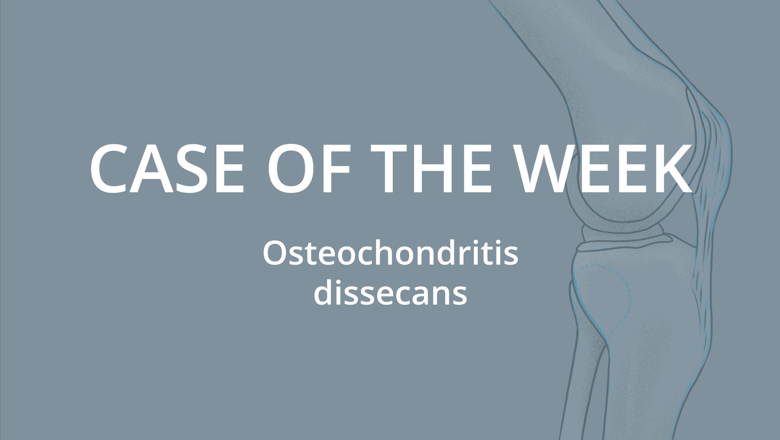 Osteochondritis dissecans | Orthopäde Wien