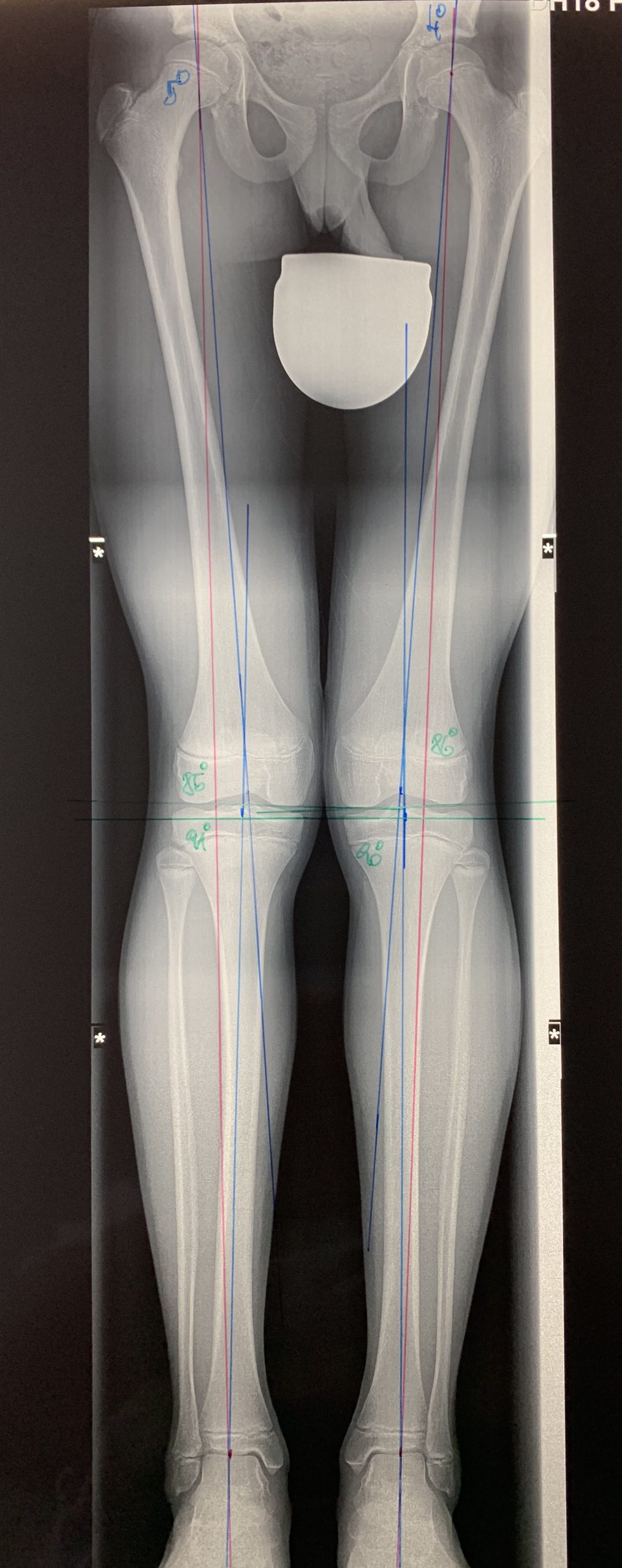 Epiphysiodese | Orthopedist Vienna